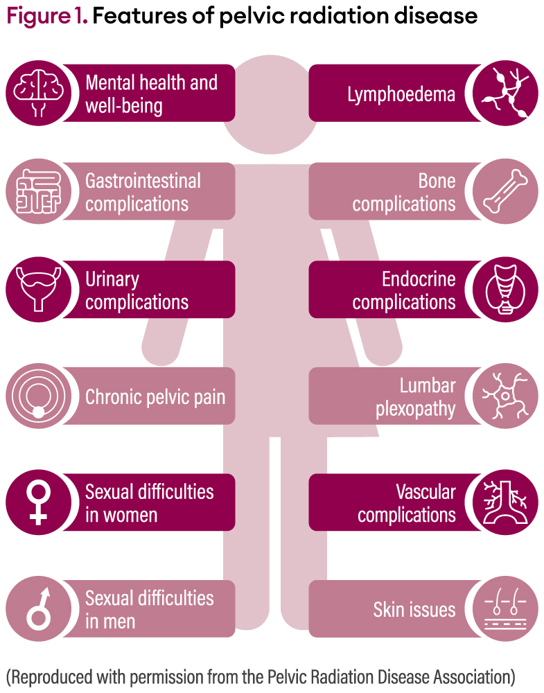 Pelvic radiation disease: role of cancer nurses in patient assessment ...