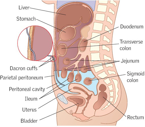 Peritoneum Kidney