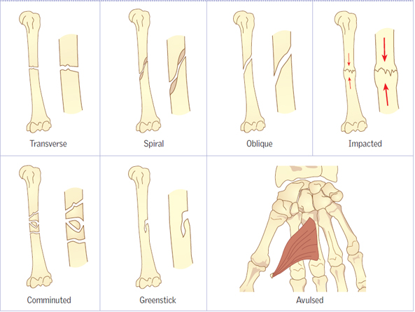 Types Of Fractures Oblique