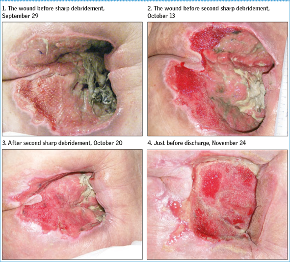debridement uk