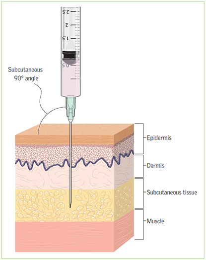 Subcutaneous Injection Mastering Subcutaneous Injections A
