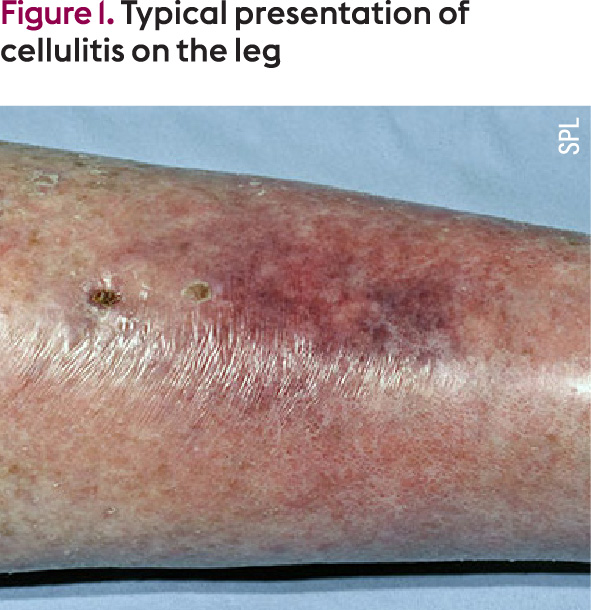 Cellulitis Nice Cks Diagnosis And Management Of Lower Limb Cellulitis