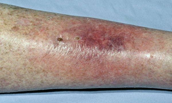 Cellulitis Nice Cks Diagnosis And Management Of Lower Limb Cellulitis