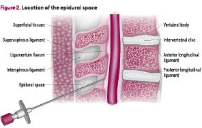 Epidural Nursing Care Plan 2009